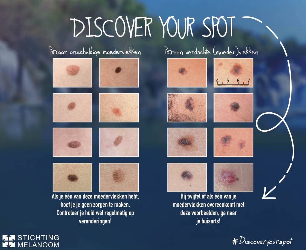 Millennials onwetend over melanoom - Gezondheid Plus